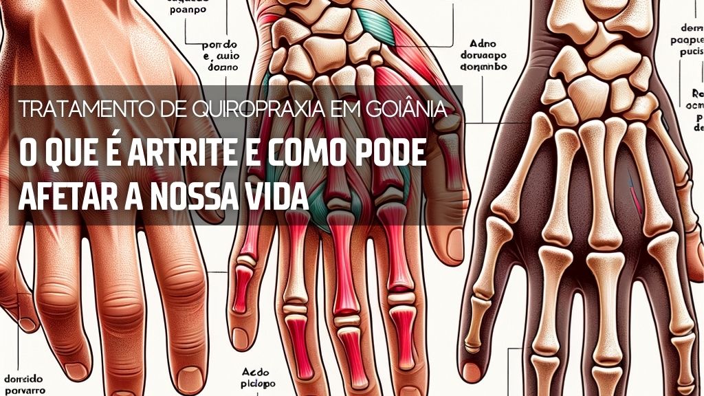 O que é Artrite 2024 - Quiropraxia em Goiânia